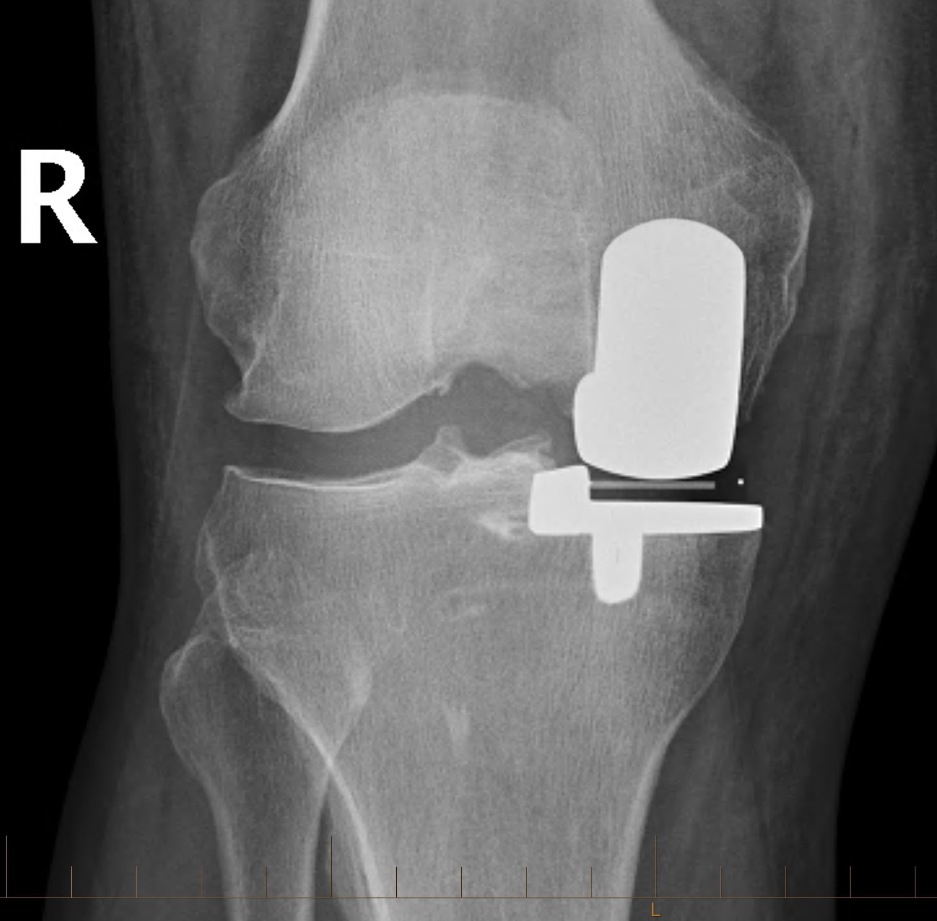 Partial Knee Replacement | Dr Simon Smith