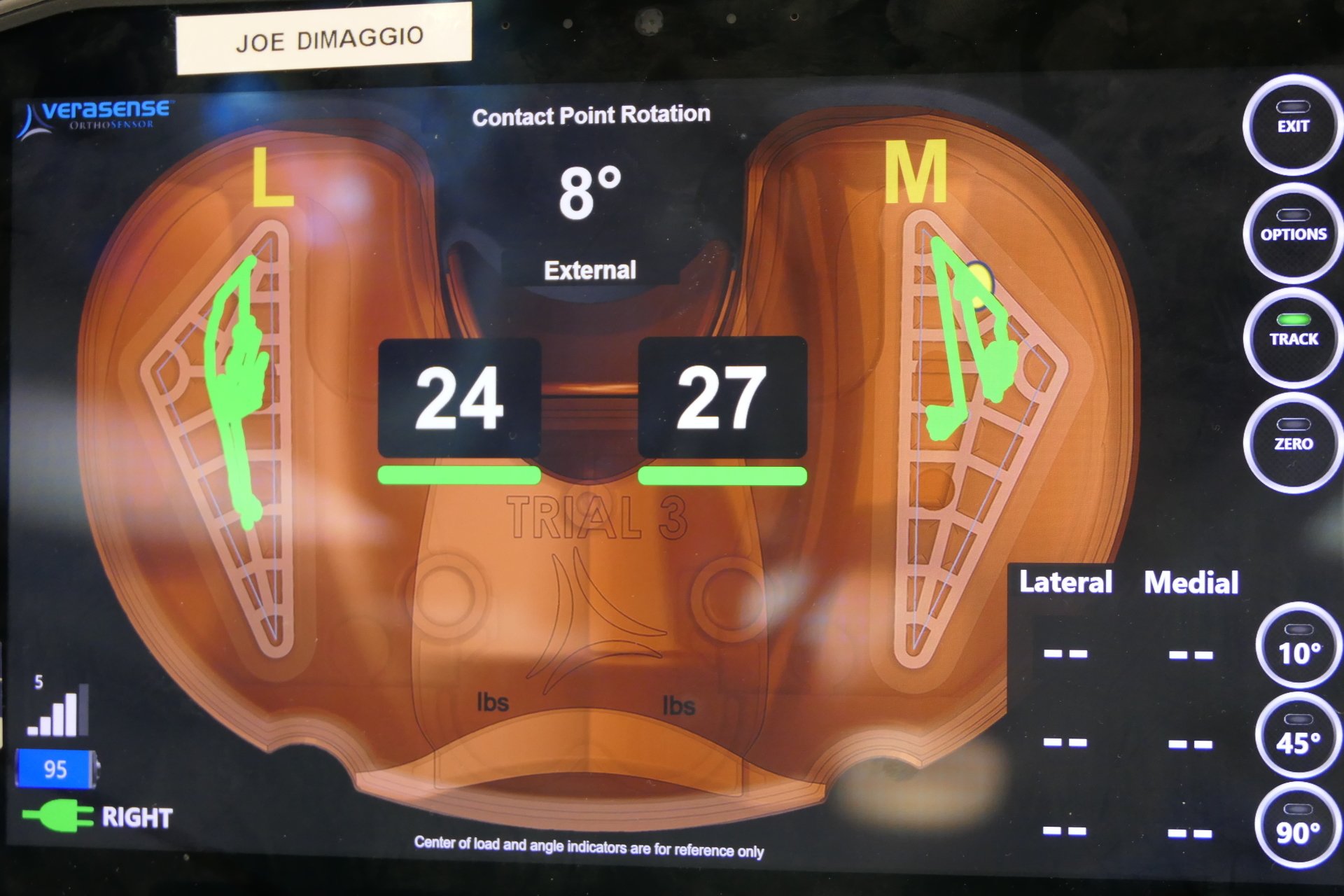 Robotic & Computer Assisted Surgery | Dr Simon Smith